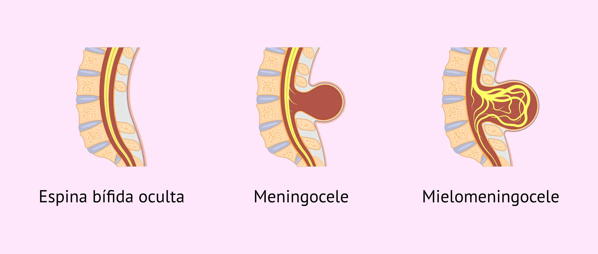 Ecografia De Espina Bifida 12 Semanas
