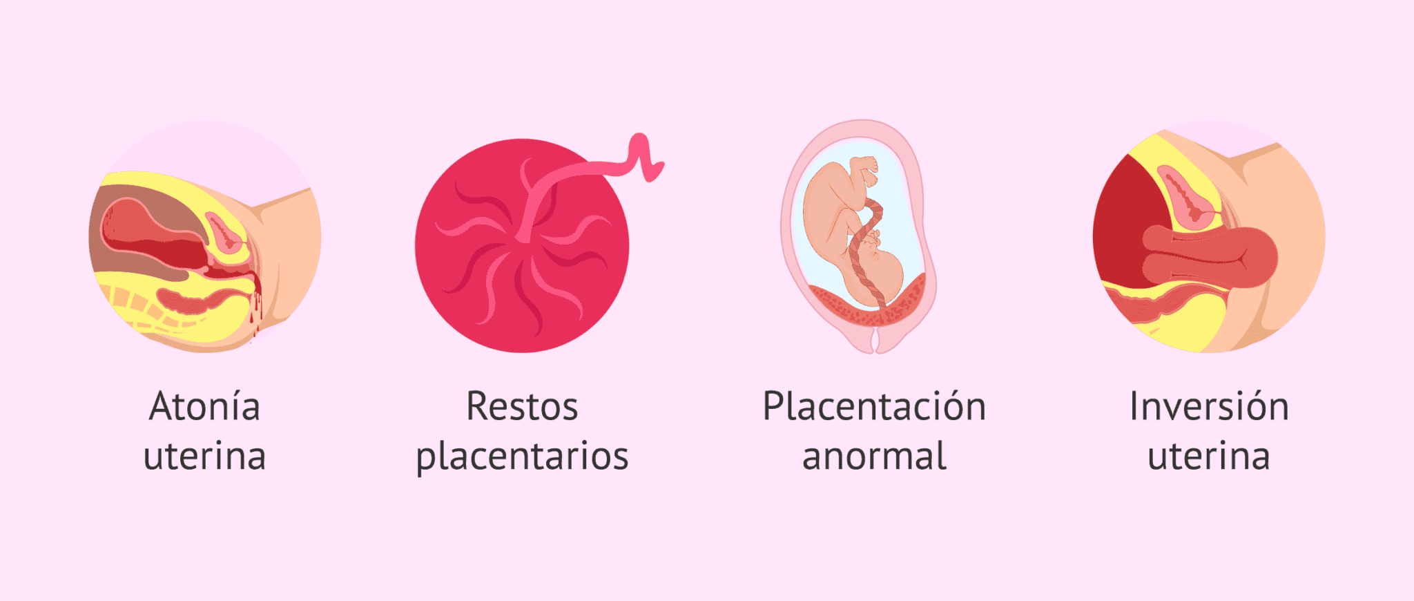 Cuáles Son Las Causas De La Hemorragia Postparto Cómo Se Trata