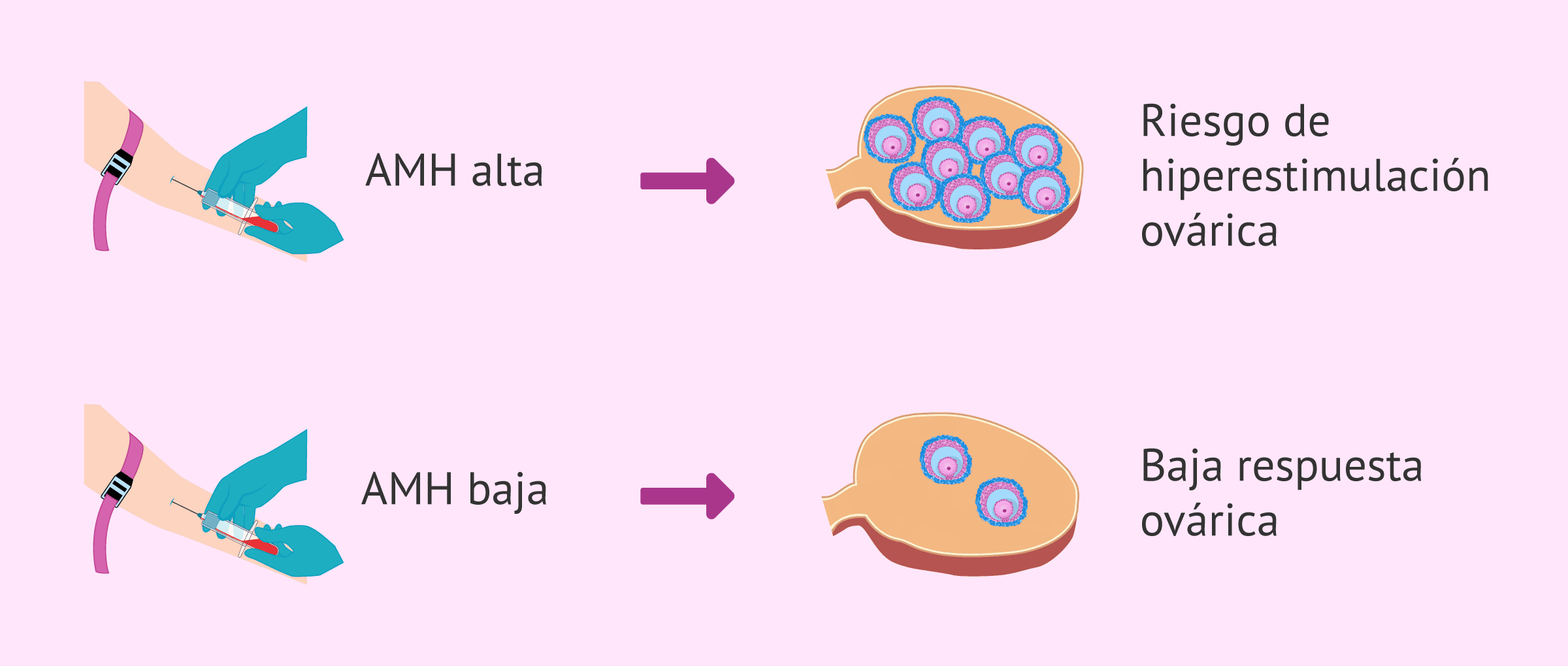 Respuesta ovárica según el valor de AMH