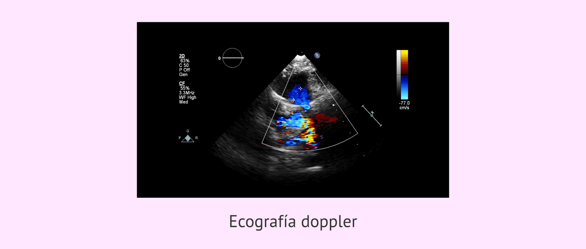 ¿Qué es una ecografía Doppler?