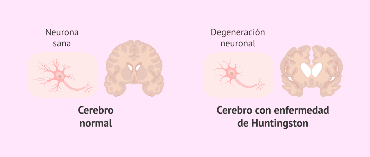 ¿En qué consiste la enfermedad de Huntington? ¿Se previene con DGP?