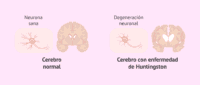 ¿En qué consiste la enfermedad de Huntington? ¿Se previene con DGP?