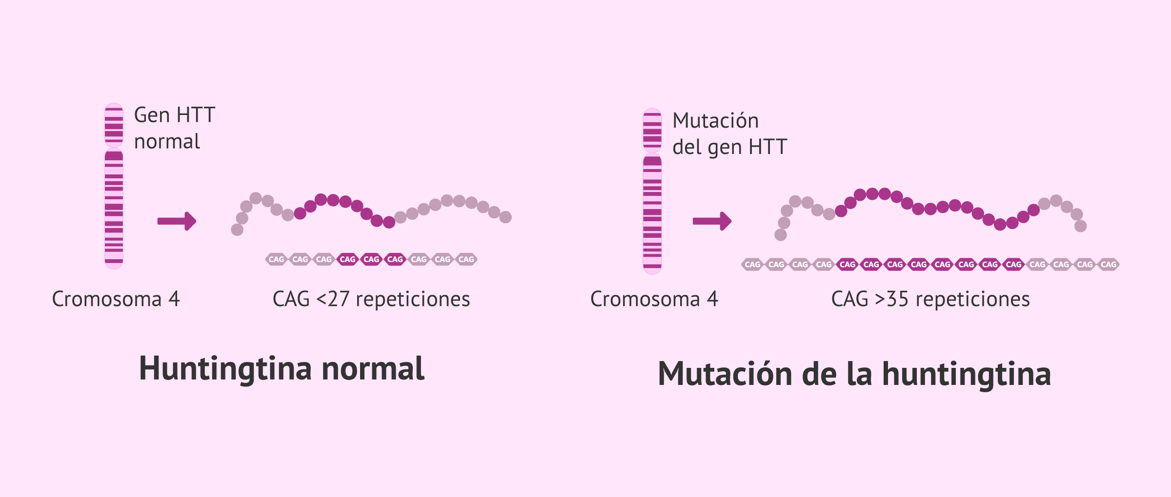 ¿En qué consiste la enfermedad de Huntington? ¿Se previene con DGP?