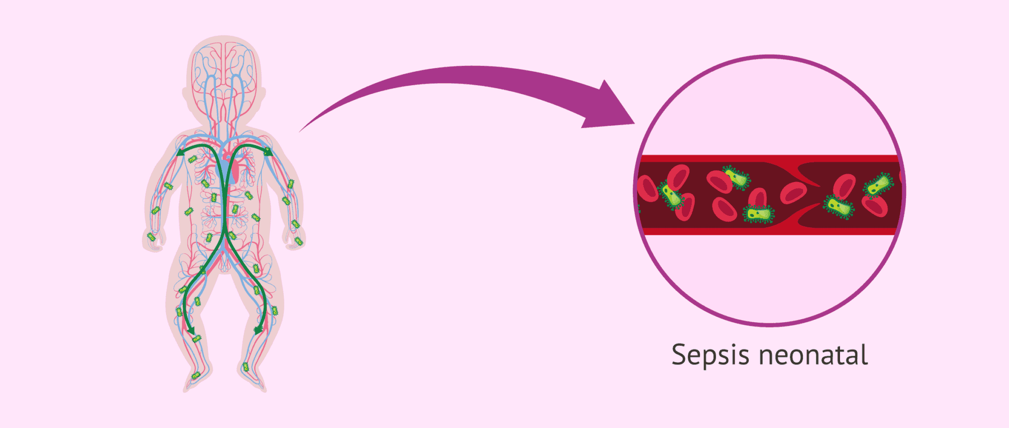 ¿Qué es la sepsis neonatal?