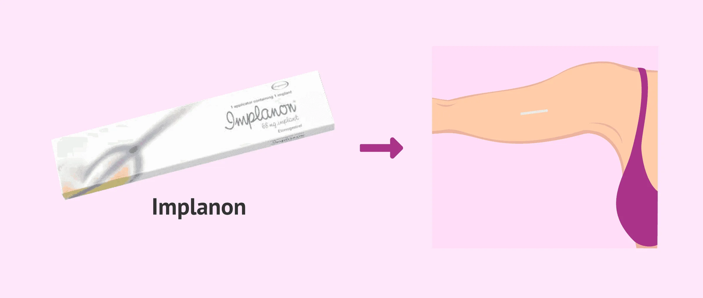 Que Es El Implanon Nxt Implanon NXT ® Implant Rod Through X Ray.