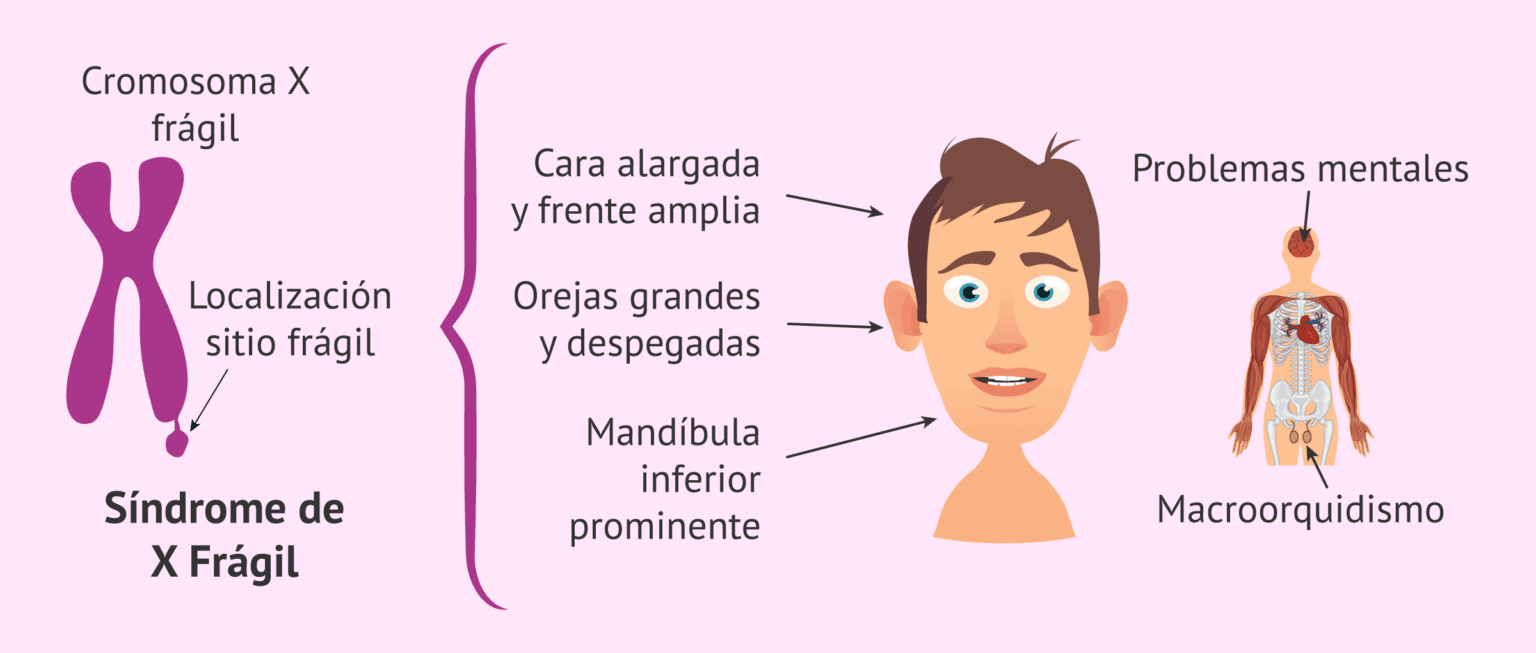 Manifestaciones clínicas del síndrome de X Frágil