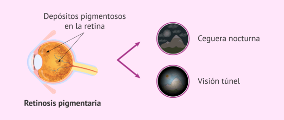 Visión con la retinosis pigmentaria