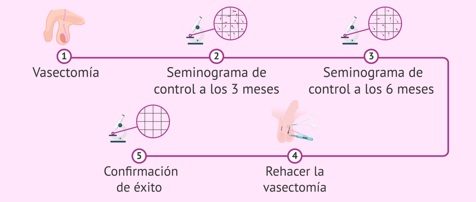 Rehacer la vasectomía tras no haber tenido éxito