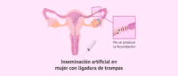 Posibilidad de embarazo con una ligadura de trompas de Falopio