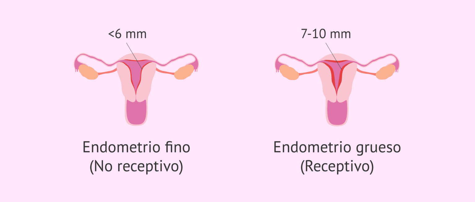 ¿Qué es el endometrio? - Engrosamiento, tipos y patologías
